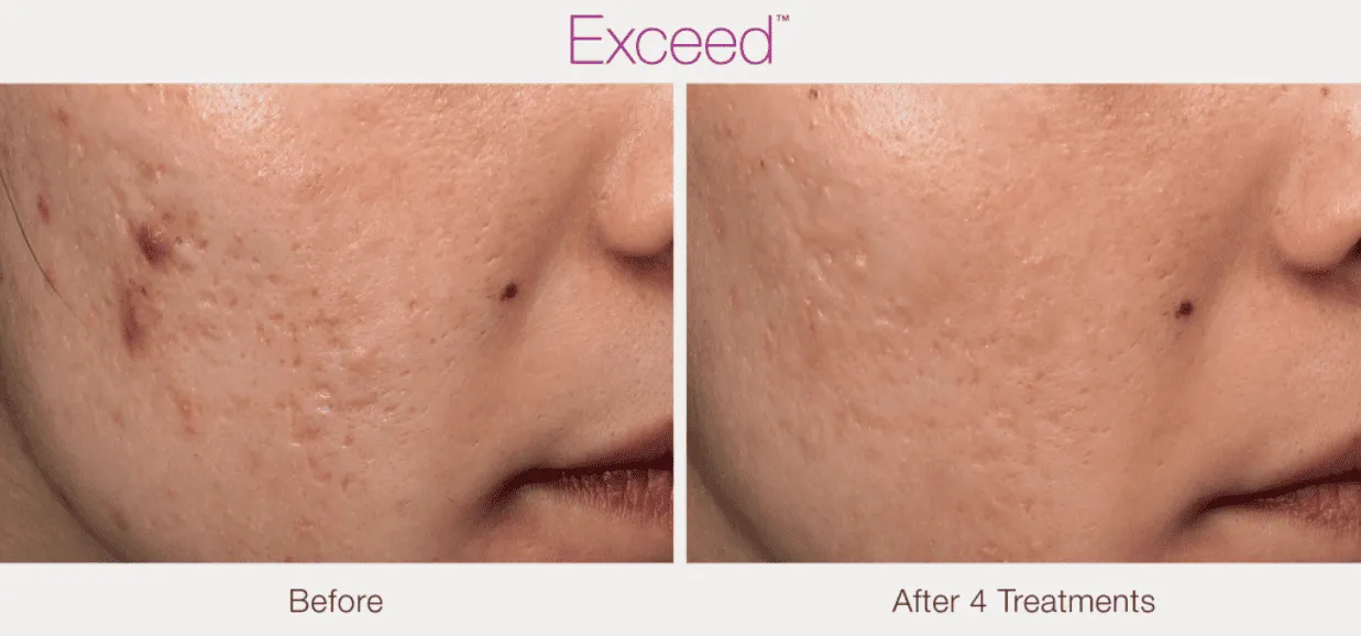 Exceed Microneedling – Diamond Advanced Aesthetics