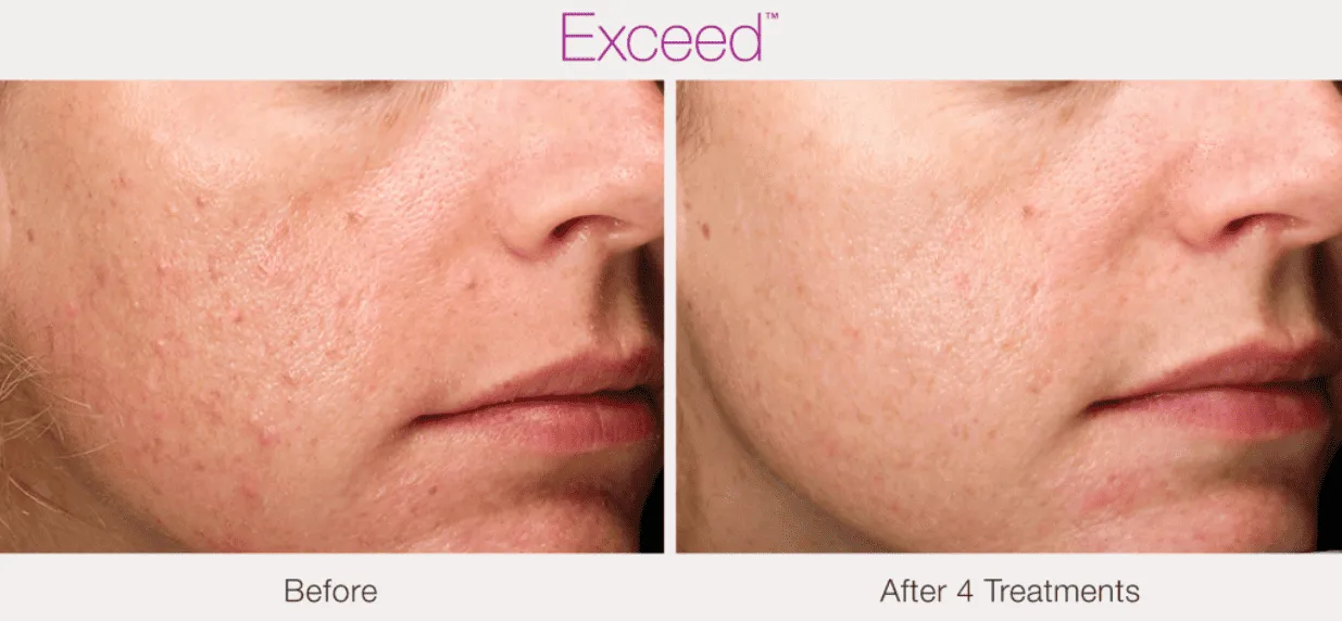 Exceed Microneedling – Diamond Advanced Aesthetics