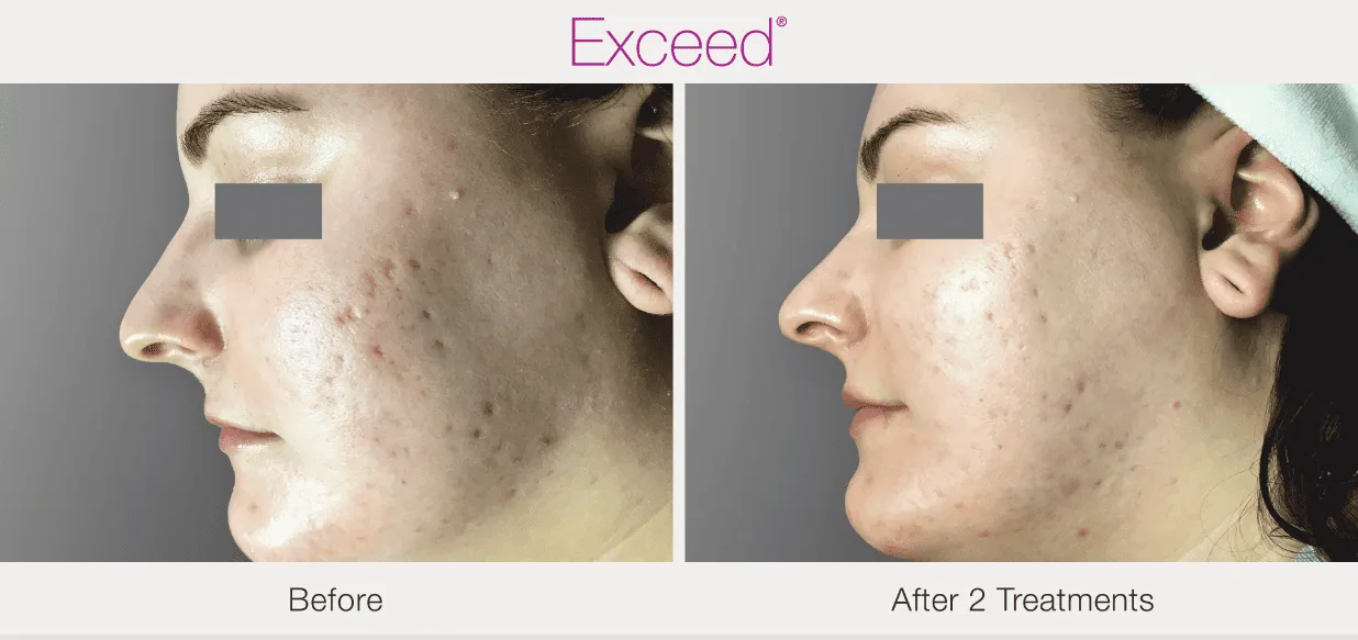 Exceed Microneedling – Diamond Advanced Aesthetics