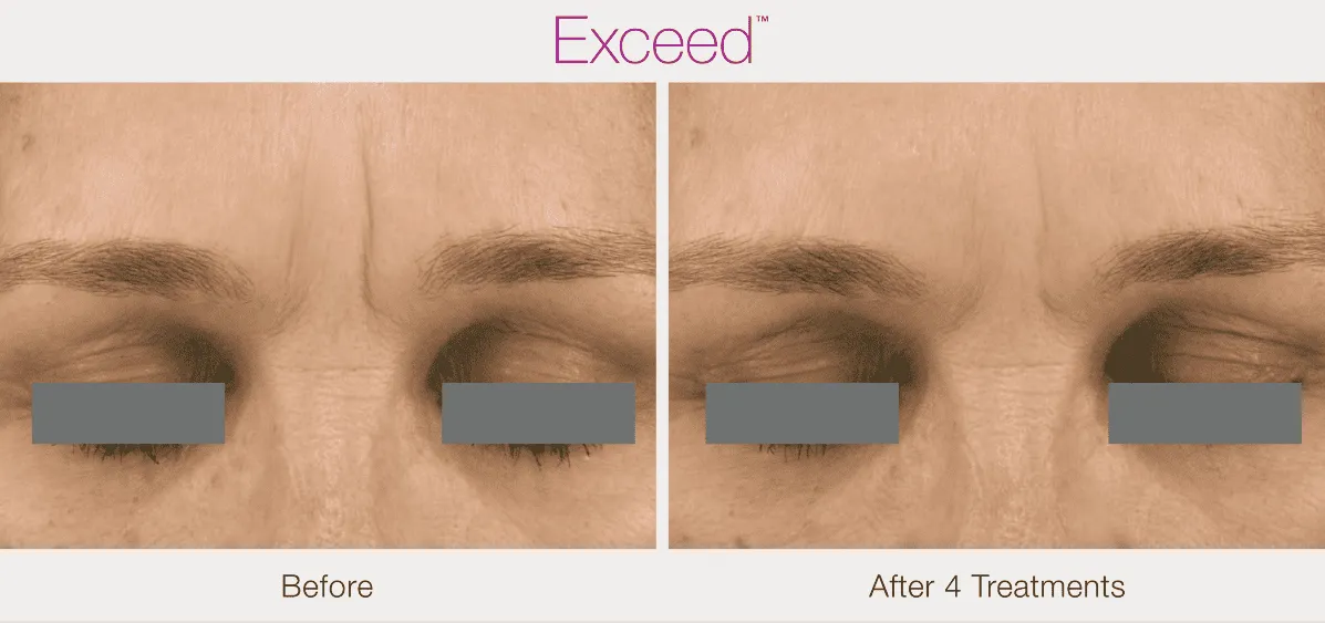 Exceed Microneedling – Diamond Advanced Aesthetics